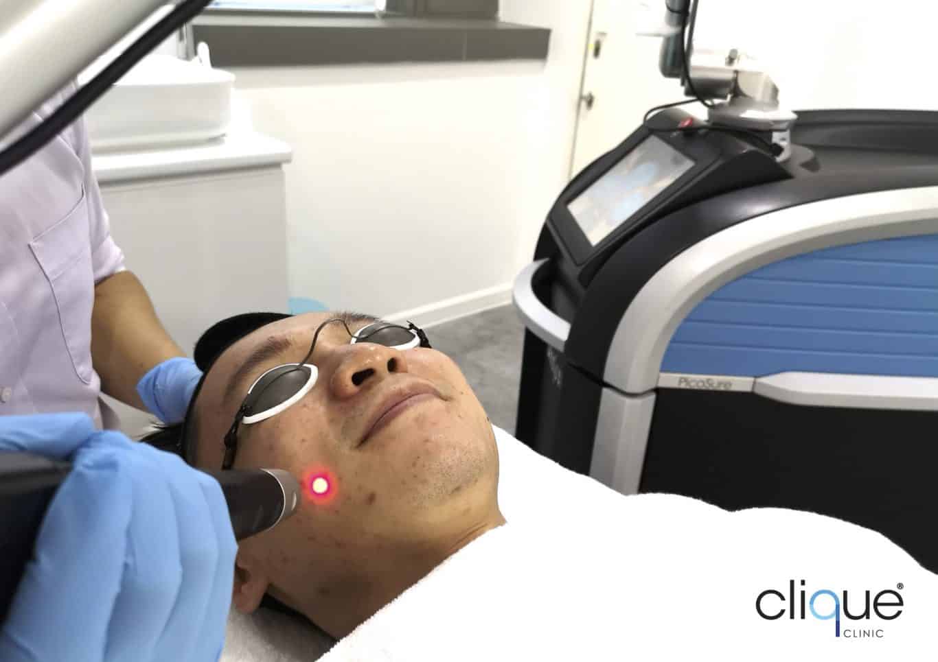 Best Laser For PIH (Post-Inflammatory Hyperpigmentation): PicoSure ...