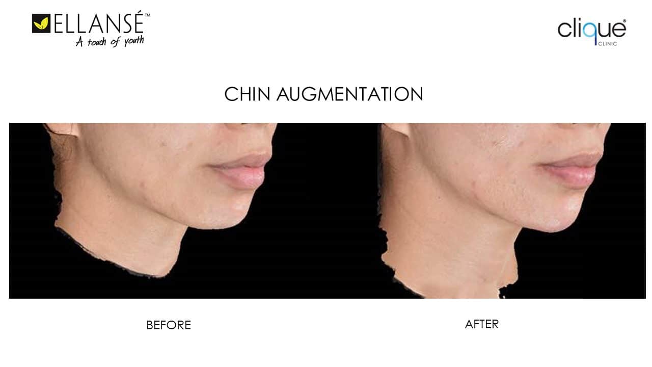 Does FDA Approve of Ellanse Filler? - Clique® Clinic Malaysia