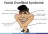How To Avoid Facial Overfilled Syndrome With Fillers? 4 Things You ...