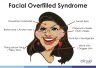 How To Avoid Facial Overfilled Syndrome With Fillers? 4 Things You ...