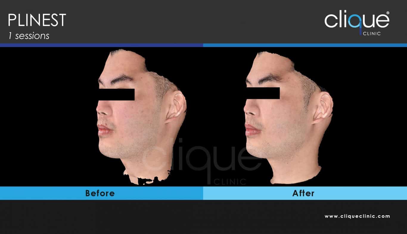 PLINEST Before And After | Clique Clinic