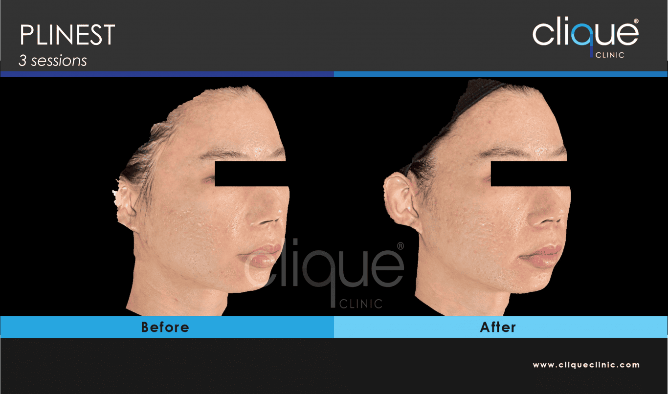 Plinest Review - 2022 | Clique Clinic