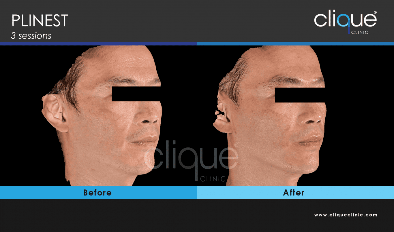 Plinest Review - 2022 | Clique Clinic