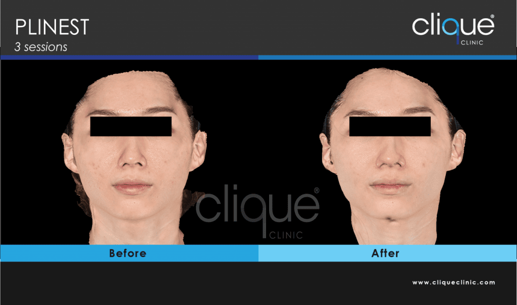 Plinest Injection Method 2022 - 3 Point Cannula | Clique Clinic