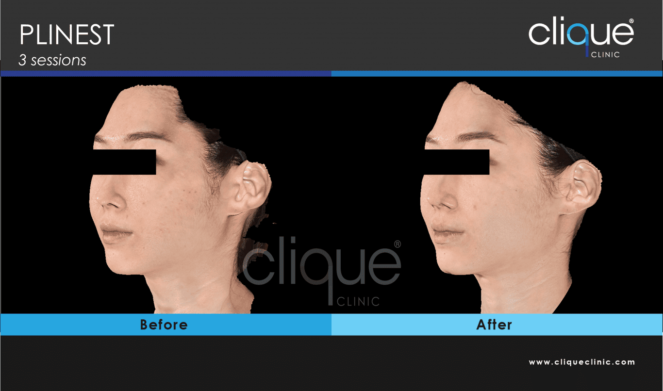 Plinest Injection Method 2022 - 3 Point Cannula | Clique Clinic