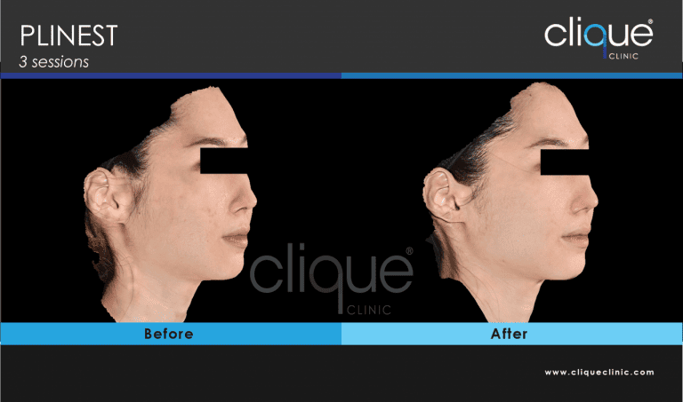 Plinest Injection Method 2022 - 3 Point Cannula | Clique Clinic