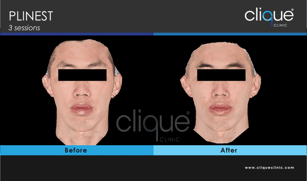 Plinest Injection Method 2022 - 3 Point Cannula | Clique Clinic