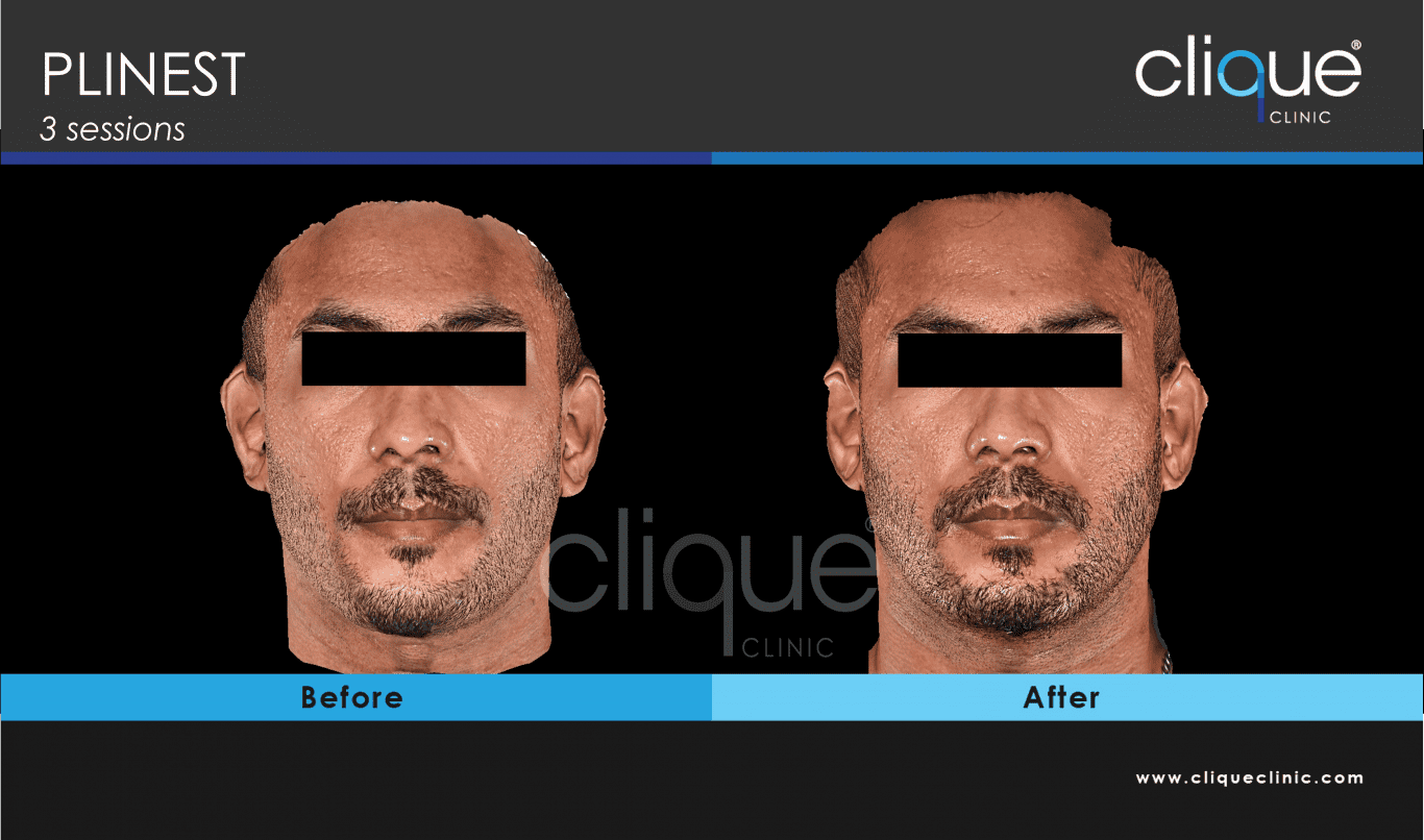 PLINEST Before And After - Year 2022 | Clique Clinic