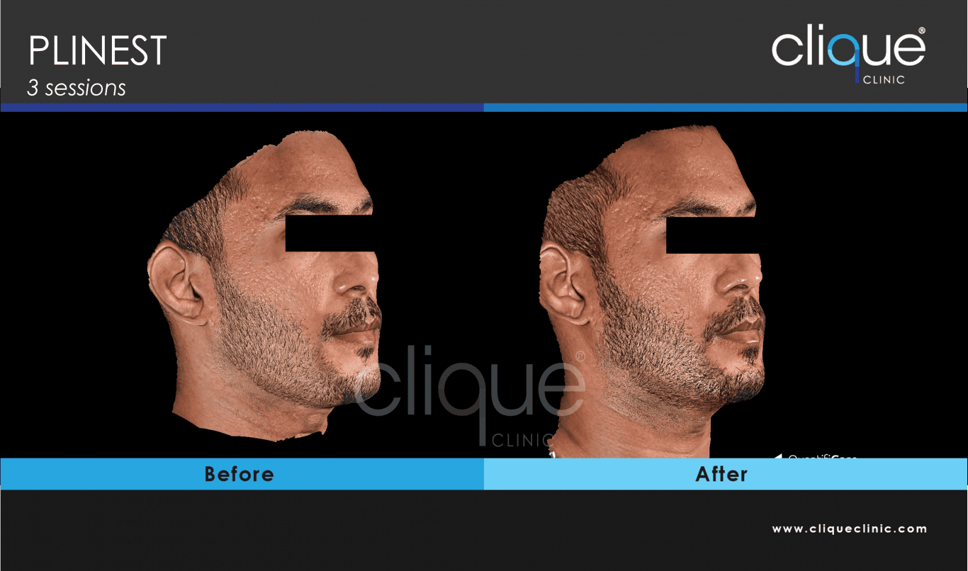 PLINEST Before And After - Year 2022 | Clique Clinic