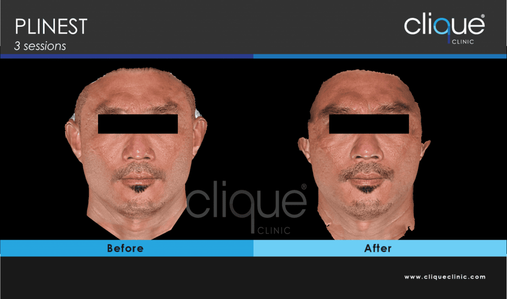 PLINEST Before And After - Year 2022 | Clique Clinic