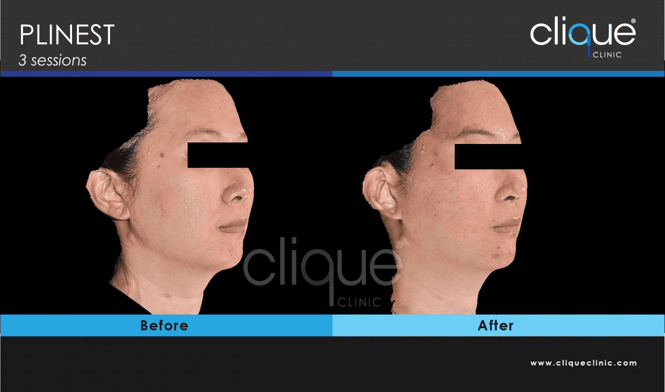 PLINEST Before And After - Year 2022 | Clique Clinic