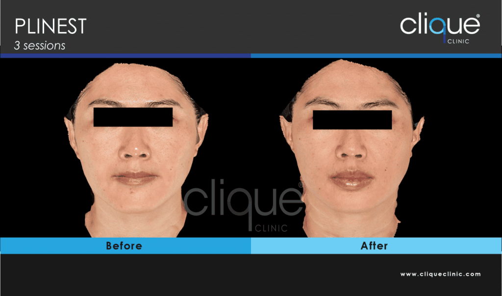 PLINEST Before And After - Year 2022 | Clique Clinic