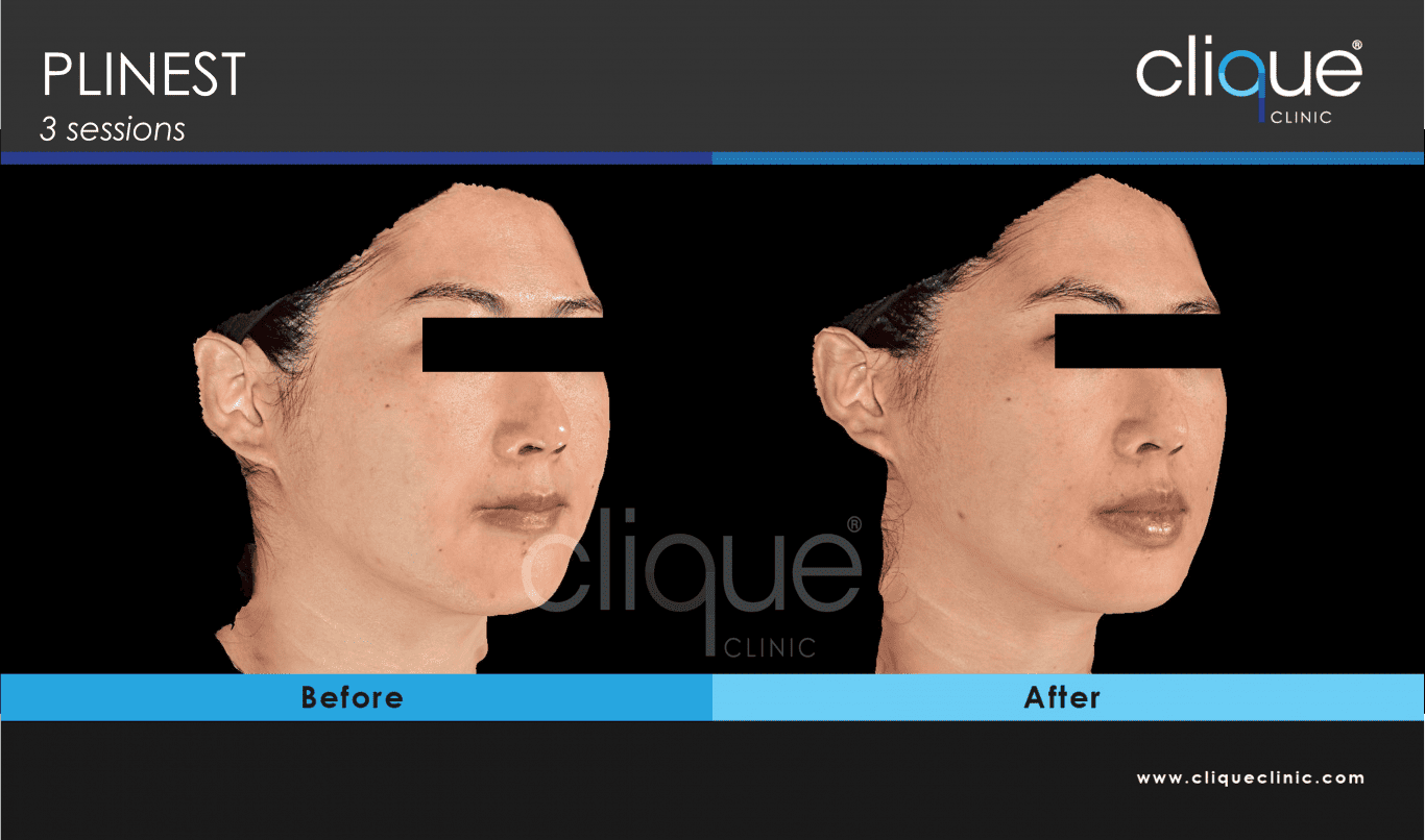 PLINEST Before And After - Year 2022 | Clique Clinic