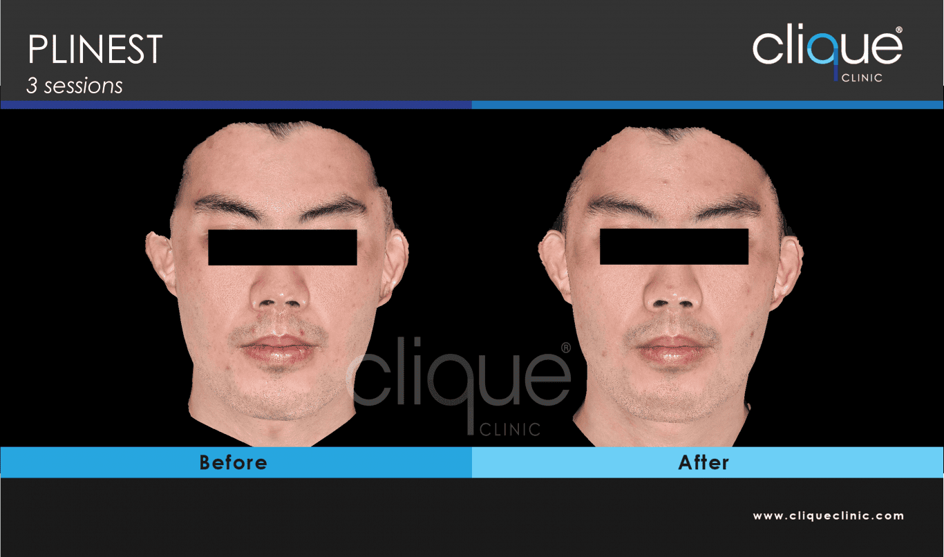 PLINEST For Men - 3 Treatments To Improve Skin Health | Clique Clinic