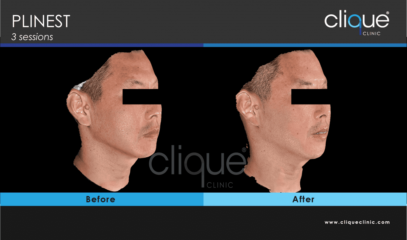 PLINEST For Men - 3 Treatments To Improve Skin Health | Clique Clinic