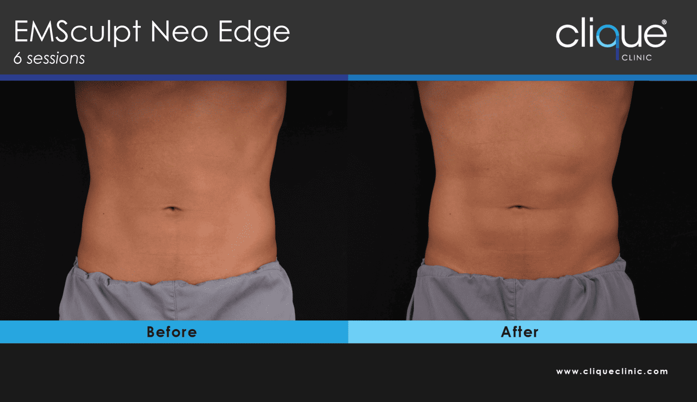 EMSculpt Neo Edge - What Body Problems Can It Fix? OR How EMSculpt NE0 ...