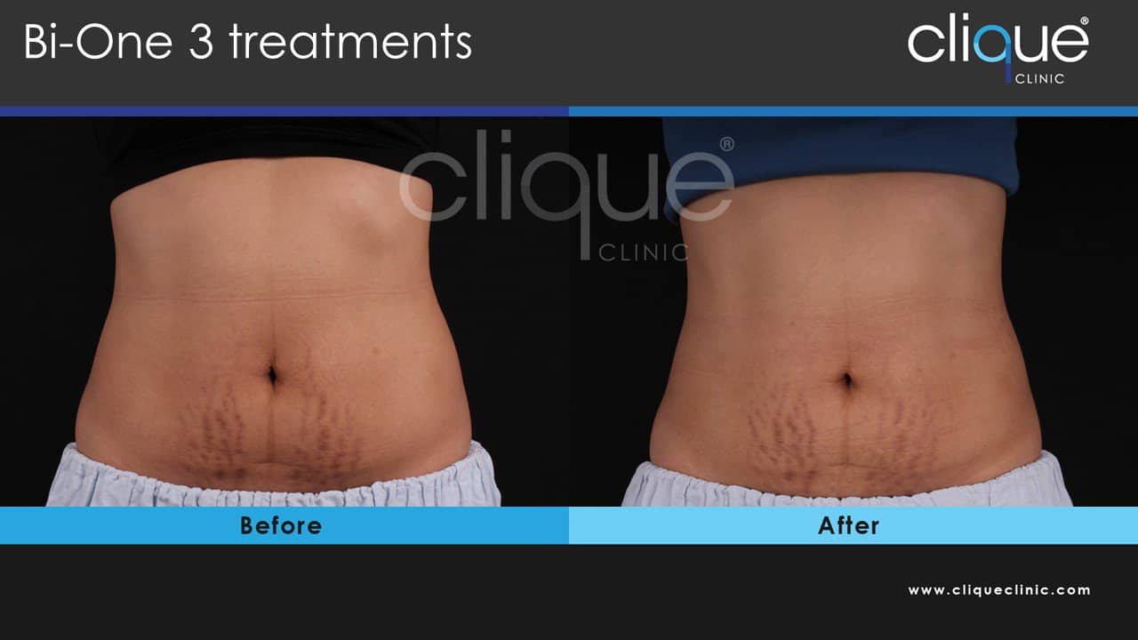 Stretch Marks Reduction: The Wonders Of Bio-One For Stretch Marks And ...