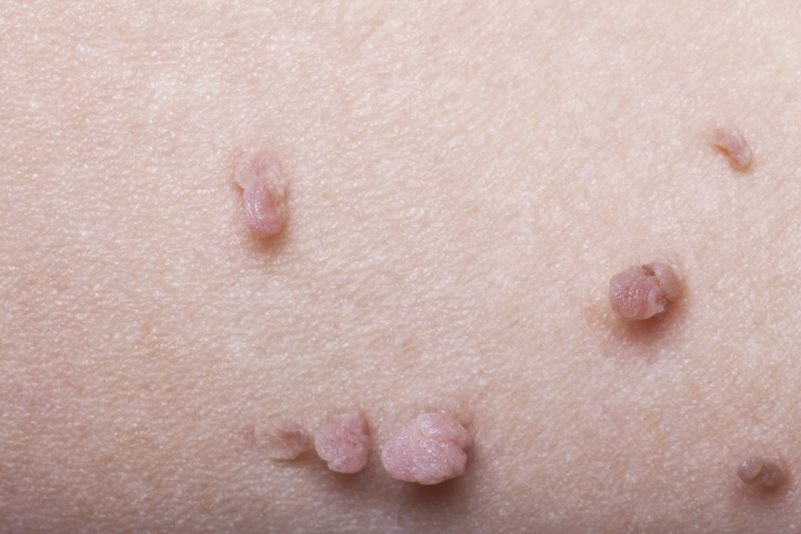 Skin Tags: What Are They, Why They Develop & Removal Methods | Clique ...