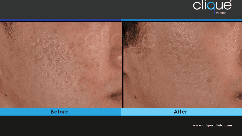 Understanding Atrophic Scars: Causes, Prevention, & Treatments | Clique Clinic