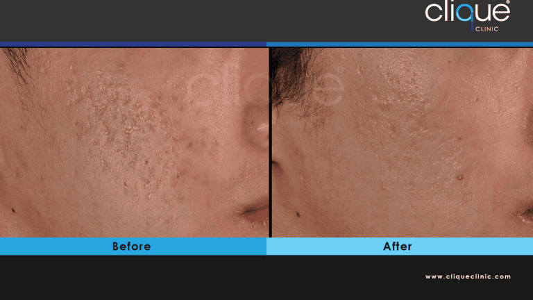 Understanding Atrophic Scars: Causes, Prevention, & Treatments | Clique ...